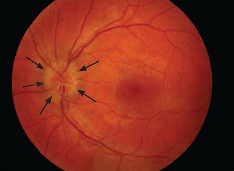 Fundus Photograph Of Papilledema Download Scientific Diagram