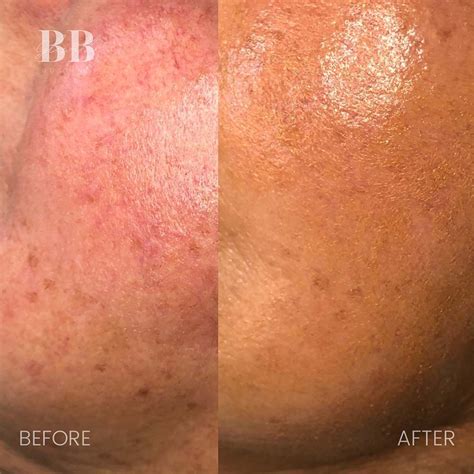 Bb Glow Before And After Pictures Gallery Best Examples