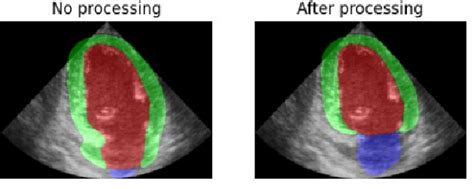 Figure 1 From Exploiting Temporal Information In Echocardiography For Improved Image