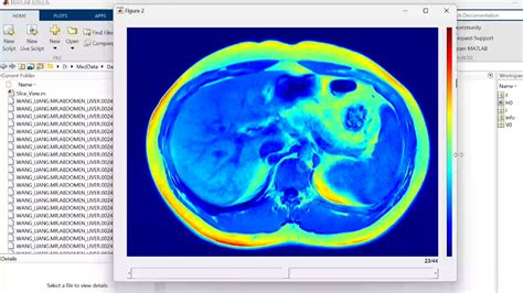 A 3d Quantification Technique For Liver Fat Fraction Distribution Analysis Using Dixon Magnetic