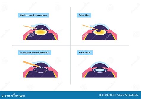 cataract surgery poster stock illustration illustration of crystalline