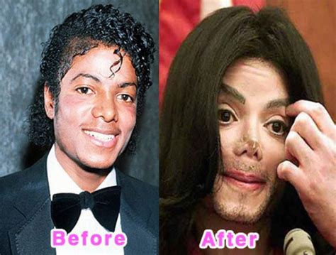 Celebrity Plastic Surgery Before And After Photos 16 Pics