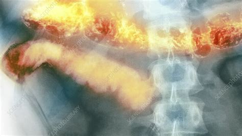 Ulcerative Colitis Animated X Ray Stock Video Clip K012 2699 Science Photo Library