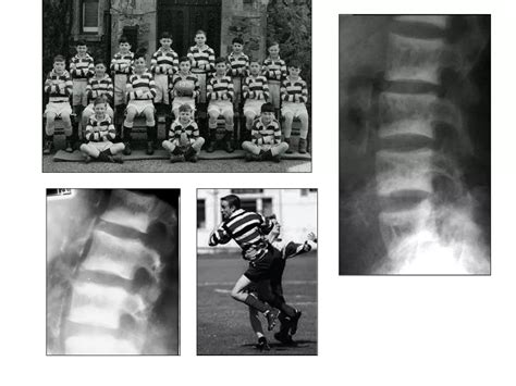 Hyperparathyroidism Pptx
