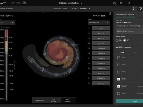 New Features In Otoplan Enhanced Hearing Implant Individualization Med El Professionals Blog