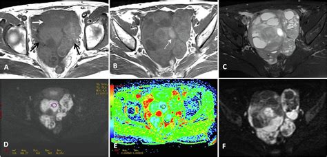 Combination Of Clinical And Mri Features In Diagnosing Ovarian