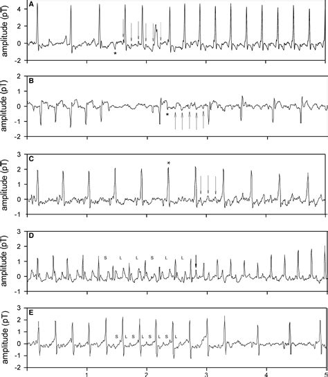 Fetal Atrial Flutter Electrophysiology And Associations With Rhythms Involving An Accessory