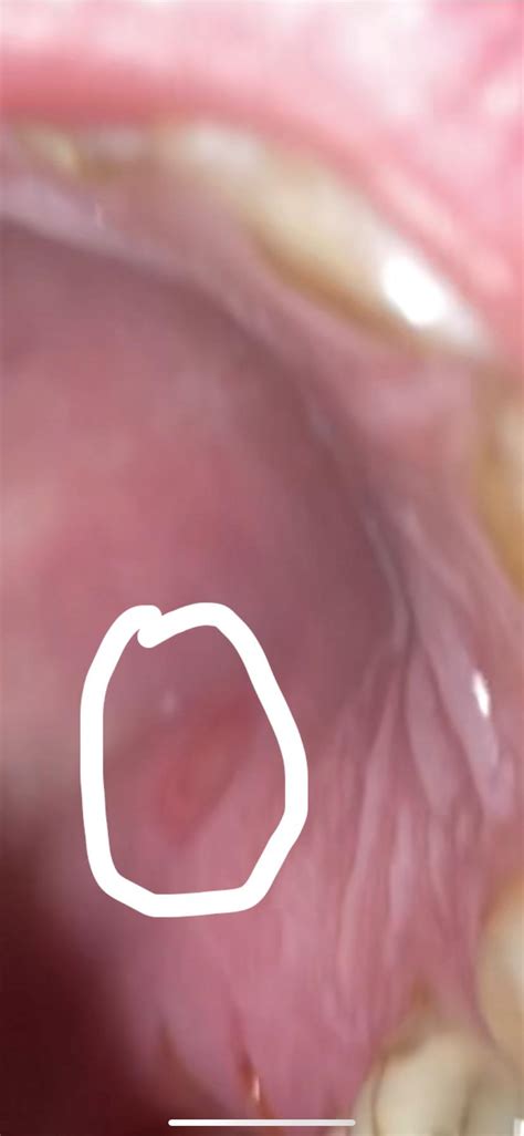 Palatal Ulcer Raskdentists