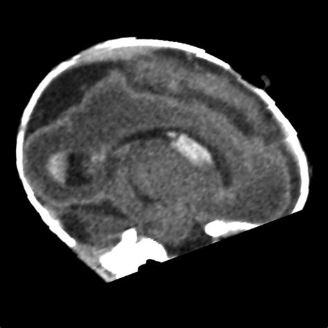 Germinal Matrix Anatomy