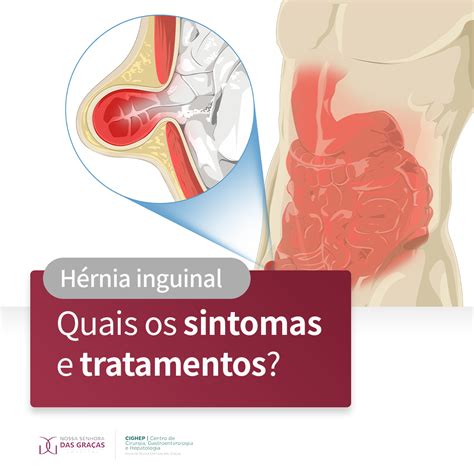 Hernia Inguinal Pode Sumir Braincp