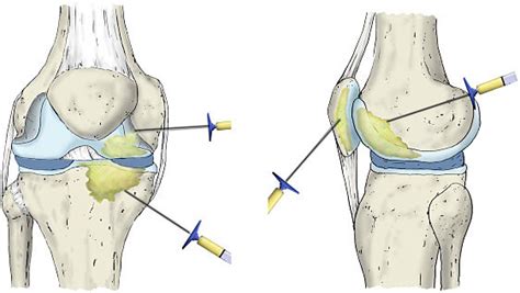 Intraosseous Injections For Advanced Joint Disease