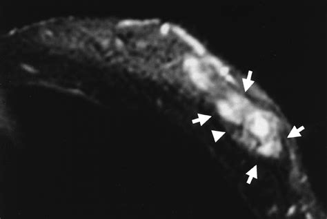 Dynamic Mri Of Fibromatosis Of The Breast Ajr