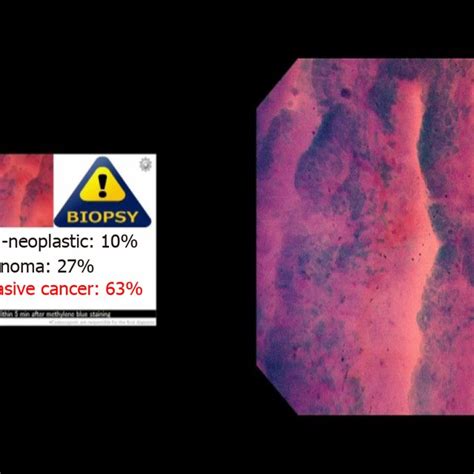 Prediction Of Colorectal Polyp Histology By The Endobrain Download Scientific Diagram