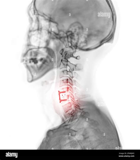 X Ray C Spine Or X Ray Image Of Cervical Spine Lateral View Showing Fixed Screw Stock Photo Alamy