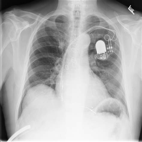 Object Detection Chest X Ray Object Detection Dataset By Azad