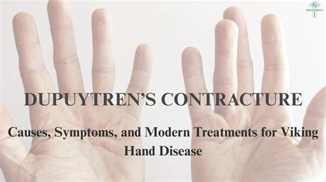 Dupuytrens Disease How To Recognize Its Early Signs Ktvs