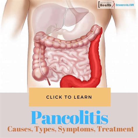 Pancolitis Causes Types Symptoms And Treatment