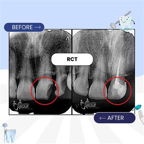 Klinik Rct Rawatan Akar Siapa Yang Perlu Dapatkan Rawatan Rct Ini