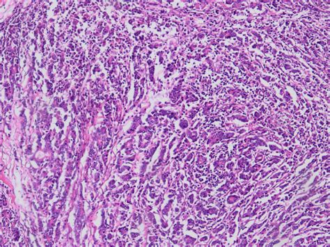 The Value Of An Mri‐based Radiomics Model In Predicting The Survival And Prognosis Of Patients