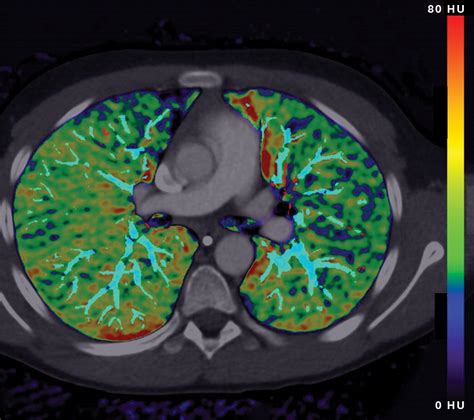 Dual Energy Ct For Pediatric Thoracic Imaging A Review Ajr