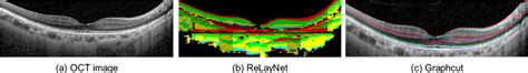 Figure 4 From The Classification Of Common Macular Diseases Using Deep Learning On Optical