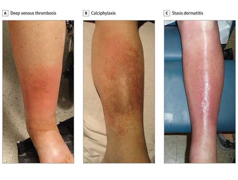 Venous Stasis Dermatitis Cellulitis