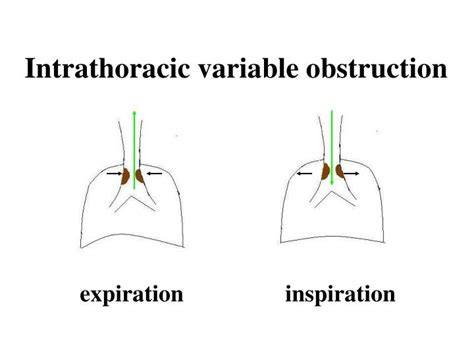Examples Of Variable Intrathoracic Obstruction At Betty Vasquez Blog