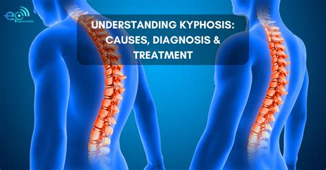 Understanding Kyphosis Causes Diagnosis And Treatment