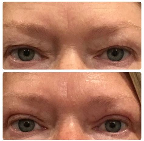 Paul B Johnson Md On Linkedin Ophthalmology Asoprs Optometry