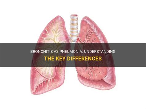 Bronchitis Vs Pneumonia Understanding The Key Differences Medshun