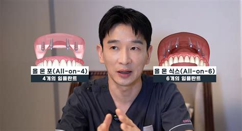 전체임플란트 올온엑스 All On X Implant 에투알드서울치과