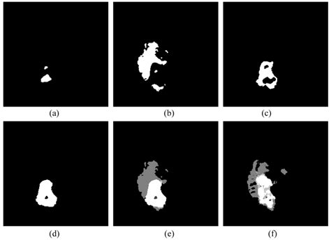 An Example Of Tumor Growth Model By Using Proposed Method For One Slice Download Scientific