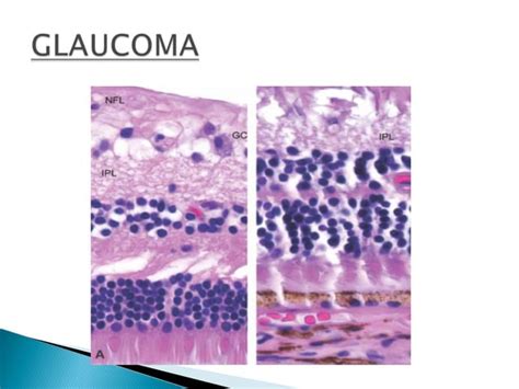 Retinal Lesions Pathophysiology Ppt