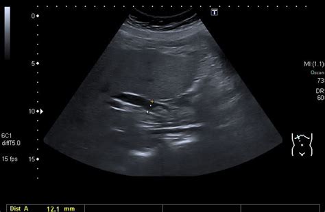 Choledocholithiasis Ultrasound Ultrasonography