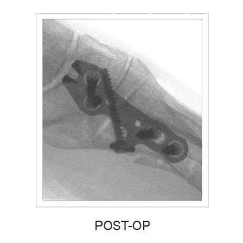 Trimed Lapidus Hook Plate Clinilab