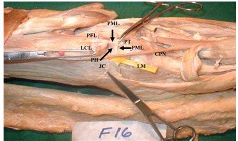 Popliteus Hiatus Ph Exposed Popliteus Tendon Pt