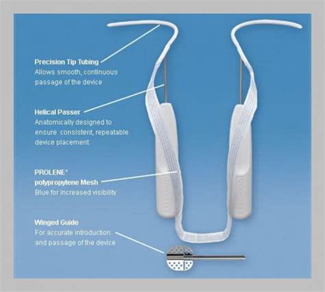 Tension Free Vaginal Tape Tvt Our Modified Technique Hot Sex Picture