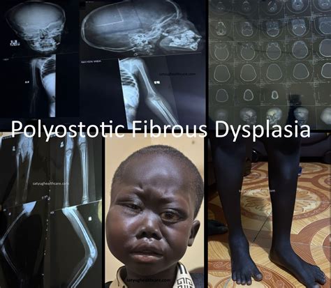 Bow Legs Genu Varum Legs Curved Deformity Correction Surgery In India