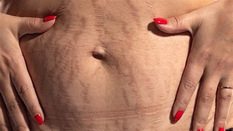 How To Minimize Stretch Marks After Pregnancy Laser Ny