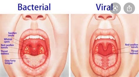 Why Is The Back Of My Throat Blue At Joe Jalbert Blog