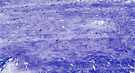 Micro Section Shows Proliferation Of Fibroblastic Cells Download