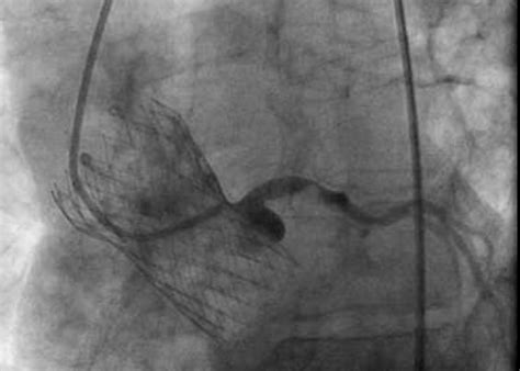 Case 7 Lm Lad Pci Cardiology Apps