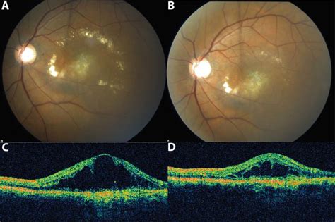 A 66 Year Old Man A Known Case Of Cscr Presented With A Chief Download Scientific Diagram