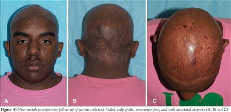 Dissecting Cellulitis