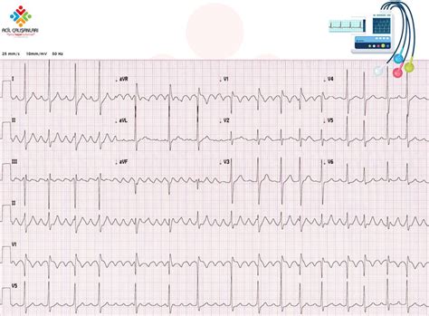 Atrial Flutter Acil Çalışanları