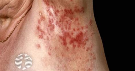 Subcorneal Pustular Dermatosis Image