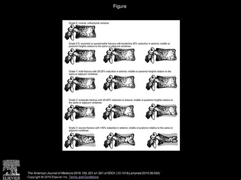 Vertebral Fractures Clinical Importance And Management Ppt Download