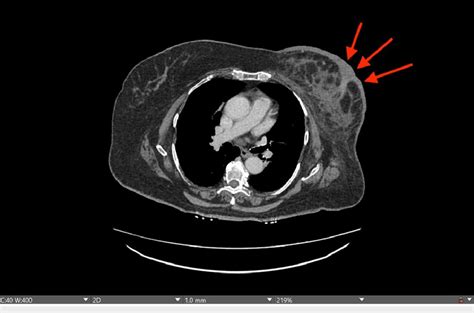 Ct Scan At The Level Of T4 Axial Contrast Enhanced Image Demonstrating Download Scientific