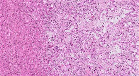Cholangiocarcinoma Atlas Of Pathology