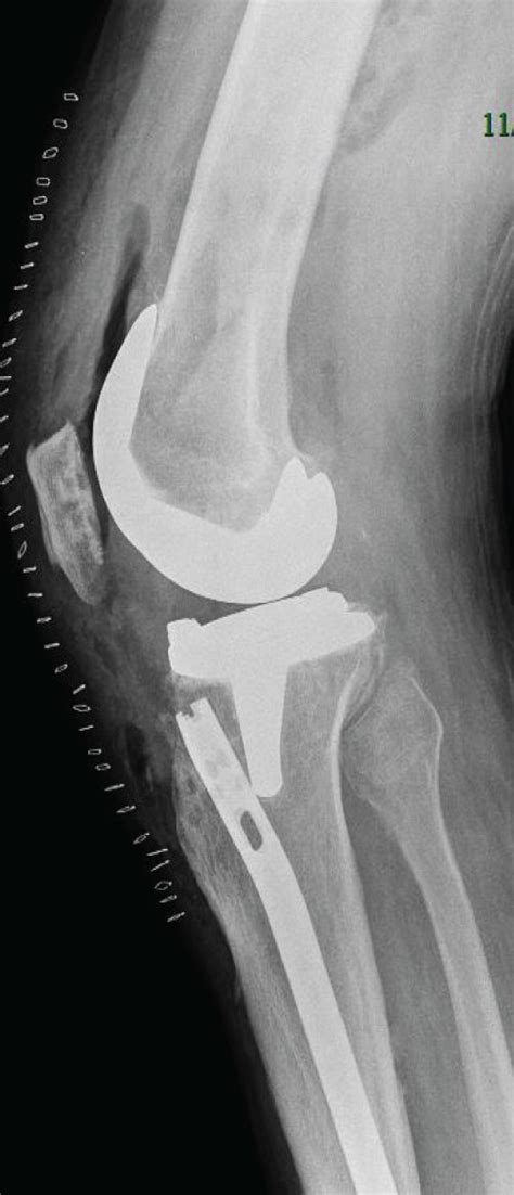 Total Knee Replacement After Removing Proximal Tibial Nail Screws